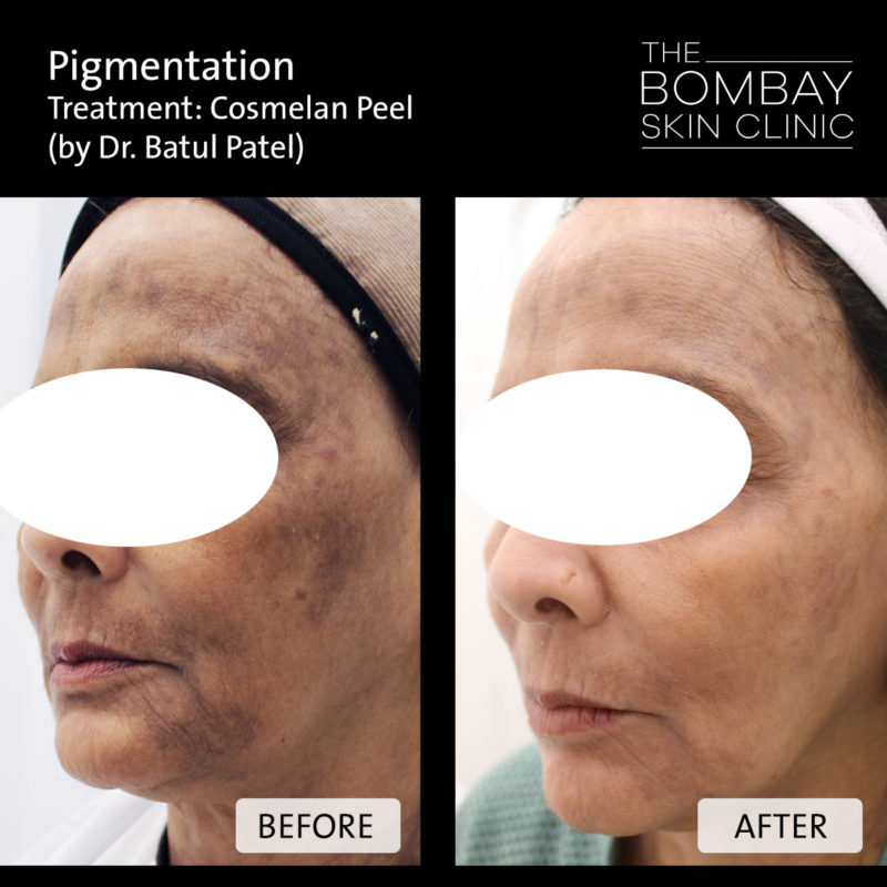 Skin Specialist in Mumbai | The Bombay Skin Clinic | Dr. Batul Patel