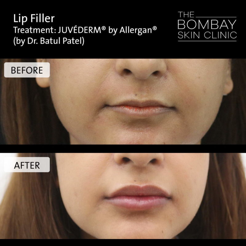 Skin Specialist in Mumbai | The Bombay Skin Clinic | Dr. Batul Patel