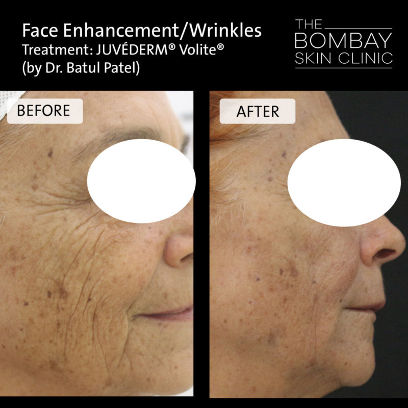 Skin Specialist in Mumbai | The Bombay Skin Clinic | Dr. Batul Patel