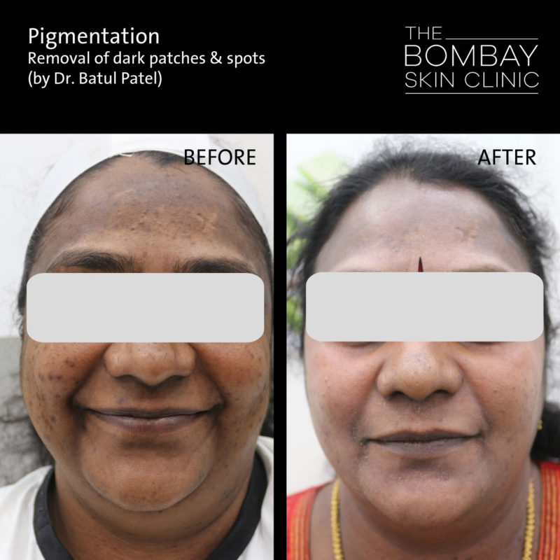 Skin Specialist in Mumbai | The Bombay Skin Clinic | Dr. Batul Patel
