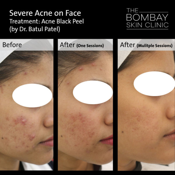 Skin Specialist in Mumbai | The Bombay Skin Clinic | Dr. Batul Patel