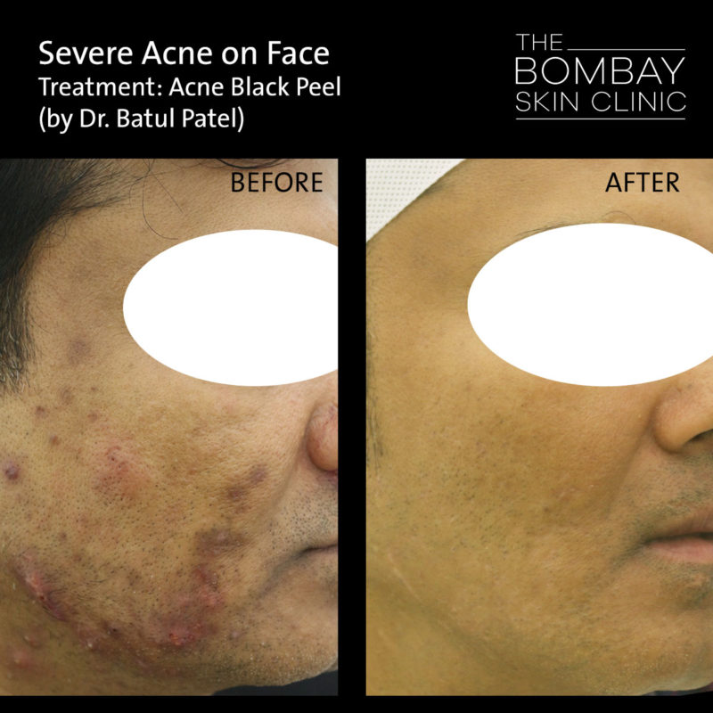 Skin Specialist in Mumbai | The Bombay Skin Clinic | Dr. Batul Patel