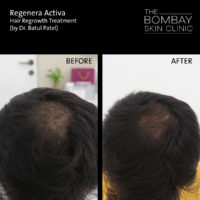 Regenera Activa Treatment for Hair Loss | The Bombay Skin Clinic