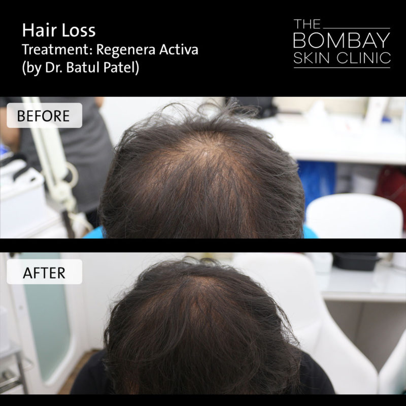 Regenera Activa Treatment for Hair Loss | The Bombay Skin Clinic