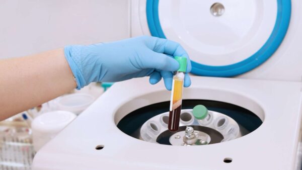 PRF Treatment in Mumbai | Advanced Platelet Rich Fibrin Therapy